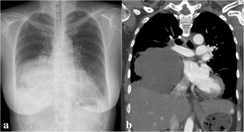 Lifesaving surgery for a ruptured invasive thymoma using the hemi ...