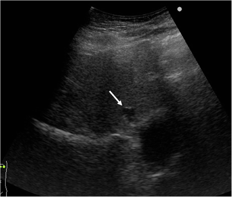 Liver abscess caused by fish bone perforation of stomach wall treated ...