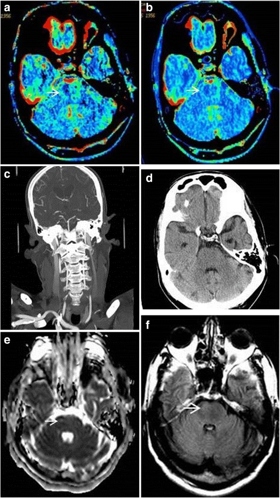 The predictive value of a targeted posterior fossa multimodal stroke ...