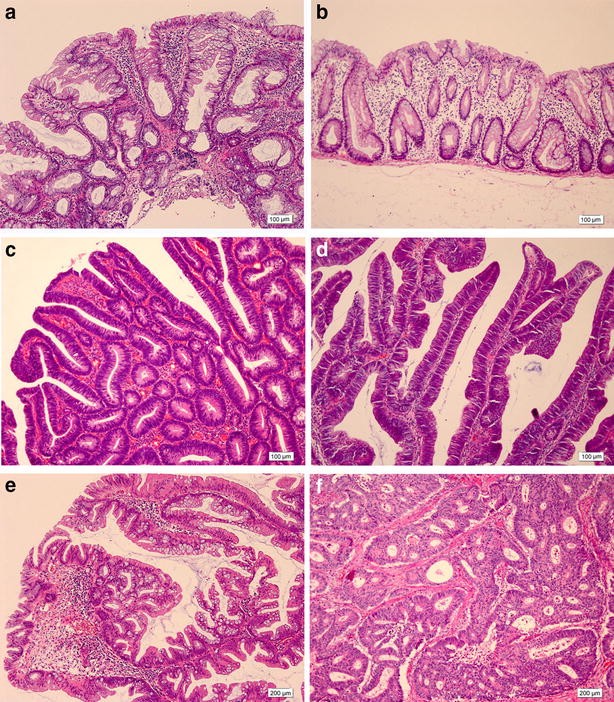 Molecular pathogenesis of sporadic colorectal cancers | Cancer ...