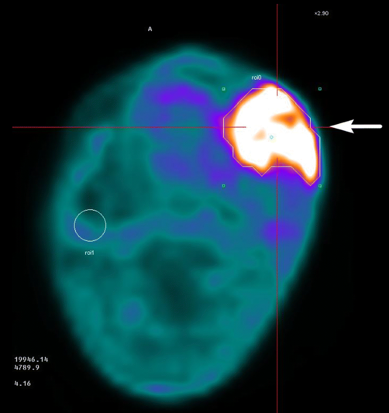 Clinical trials for treating recurrent head and neck cancer with boron ...