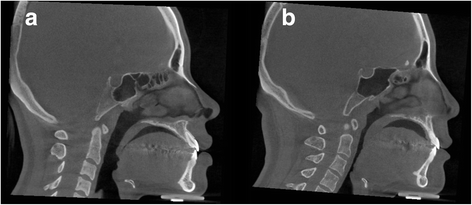 Change of the airway space in mandibular prognathism after bimaxillary ...
