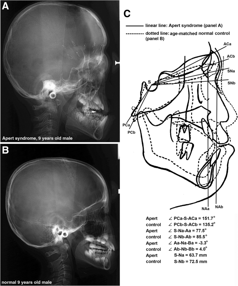 Aberrant growth of the anterior cranial base relevant to severe midface ...