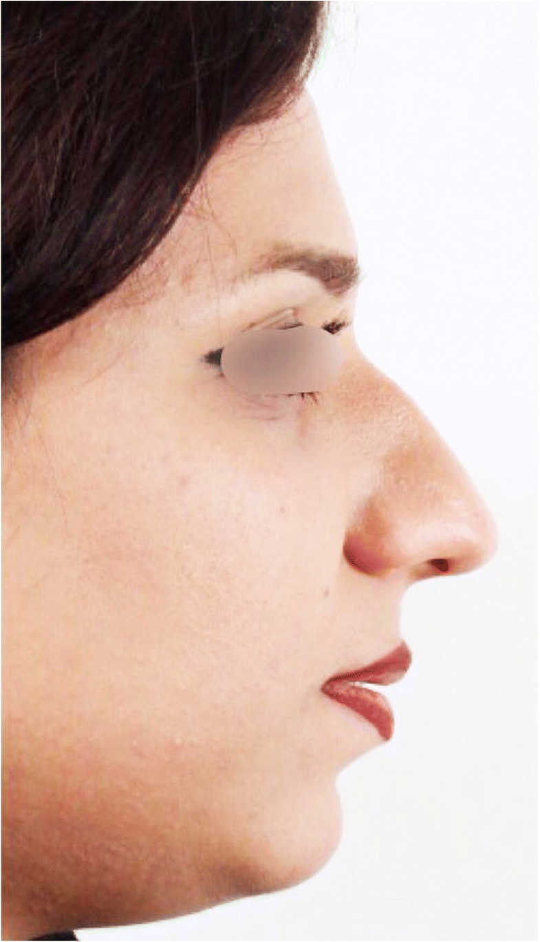 Balcony genioplasty: a novel technique for better esthetic results in ...