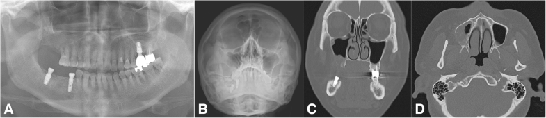 Definition And Management Of Odontogenic Maxillary Sinusitis
