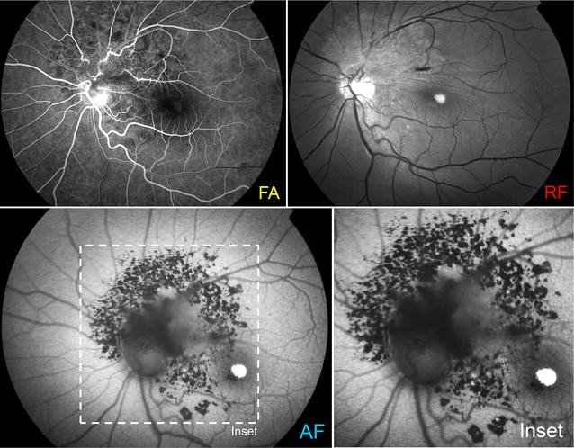 Multimodal imaging of combined hamartoma of the retina and retinal ...