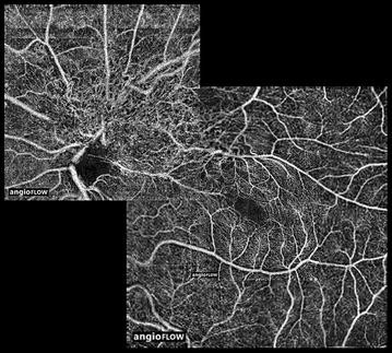 Multimodal imaging of combined hamartoma of the retina and retinal ...