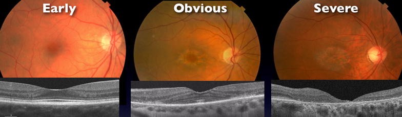 Expanded spectral domain-OCT findings in the early detection of ...