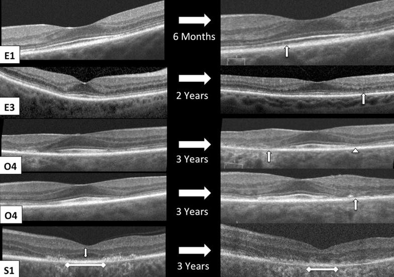 Expanded spectral domain-OCT findings in the early detection of ...