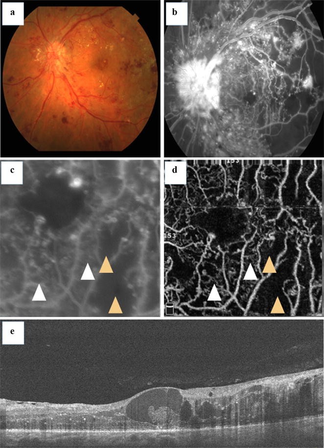 Diabetic retinopathy and OCT angiography: clinical findings and future ...