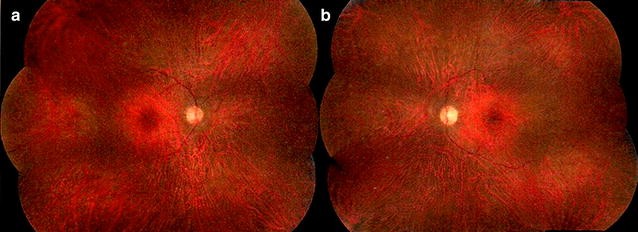 Autoimmune retinopathy: A Review | International Journal of Retina and ...