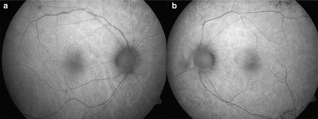 Autoimmune retinopathy: A Review | International Journal of Retina and ...
