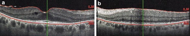 Autoimmune retinopathy: A Review | International Journal of Retina and ...