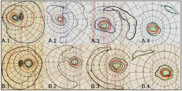 Autoimmune retinopathy: A Review | International Journal of Retina and ...