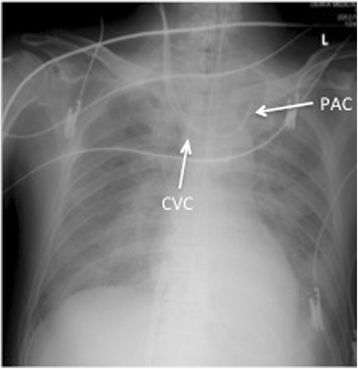 Persistent left superior vena cava with absent right superior vena cava ...