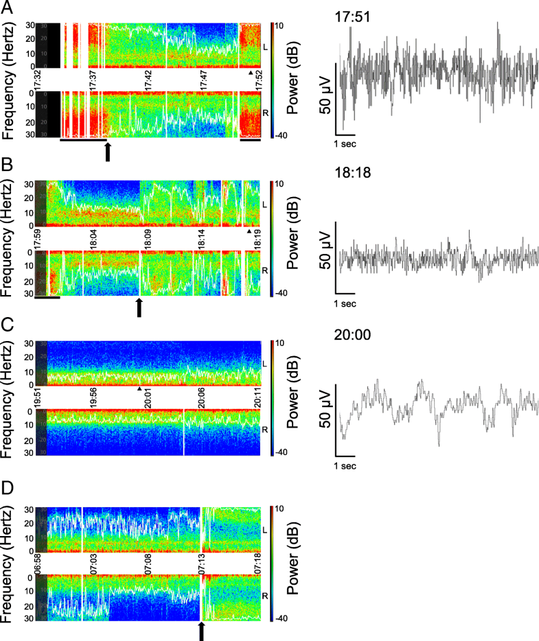 Dexmedetomidine administration in a patient with status epilepticus ...