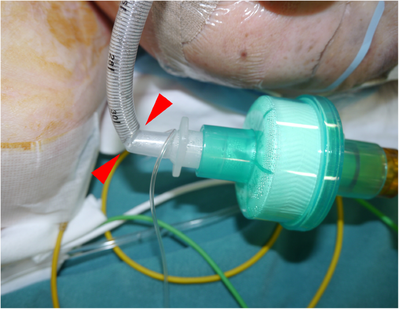 The “wireless” portion of a wire-reinforced endotracheal tube may kink ...