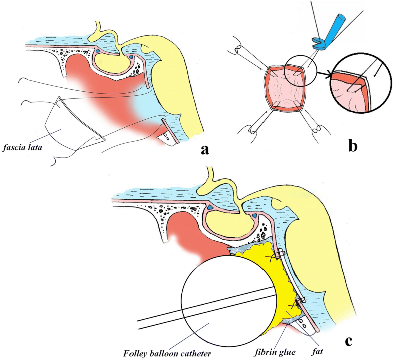 Endoscopic endonasal transclival removal of tumors of the clivus and ...