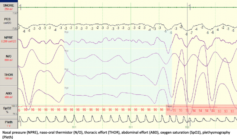 Hypopnea definitions, determinants and dilemmas: a focused review ...