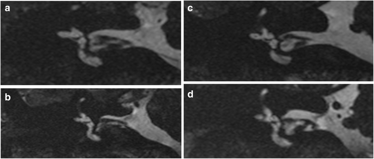 Imaging of the saccule for the diagnosis of endolymphatic hydrops in ...