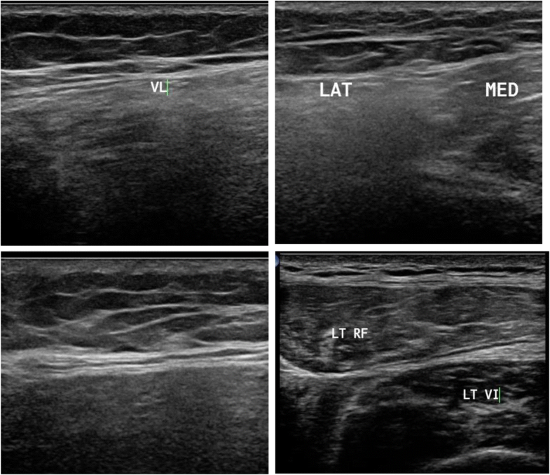 The role of muscle ultrasound in helping the clinical diagnosis of ...