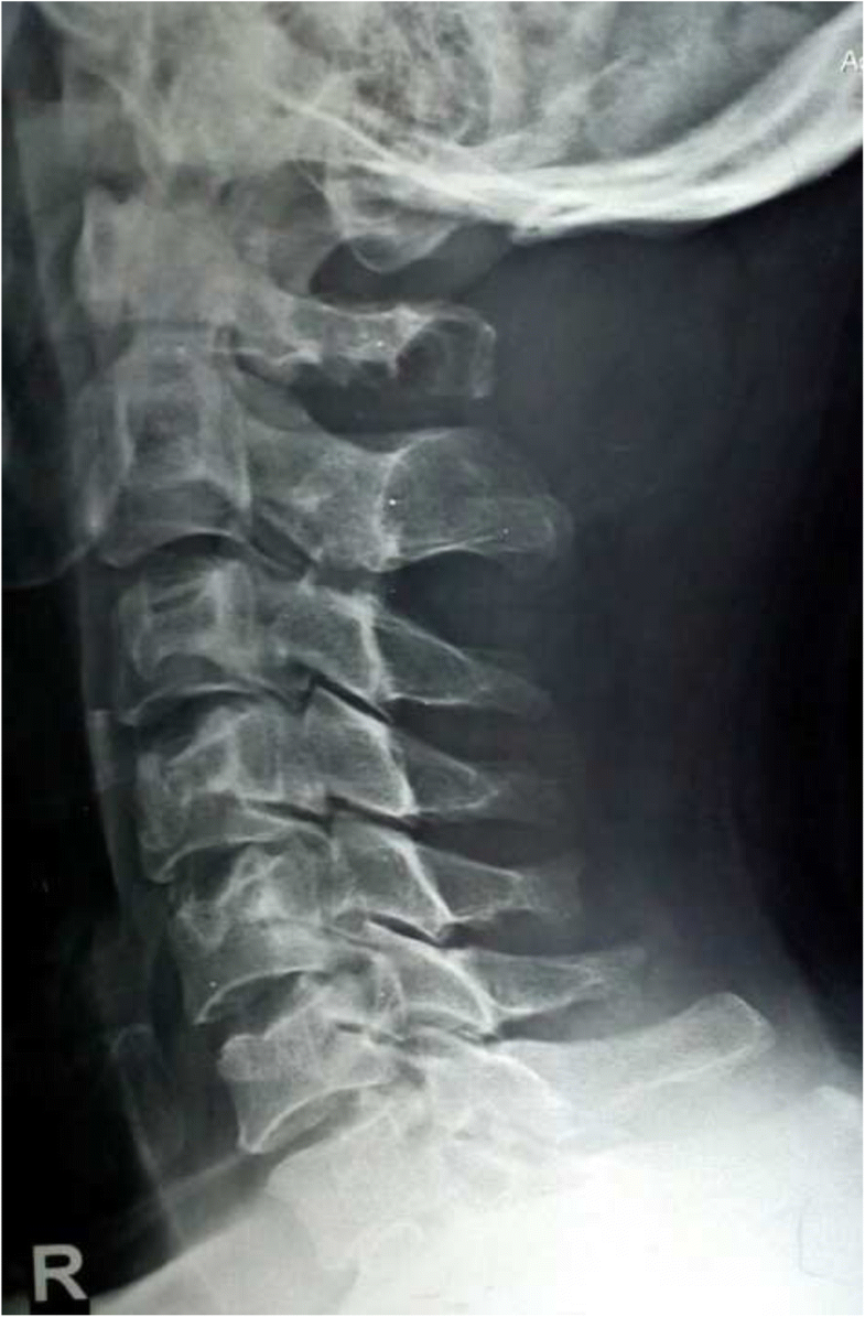 Primary para-vertebral hydatid cyst in the sub-occipital area of the ...