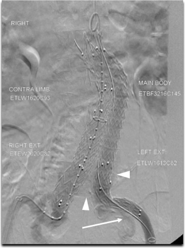 Direct puncture embolisation of the non-coil-embolised internal iliac ...