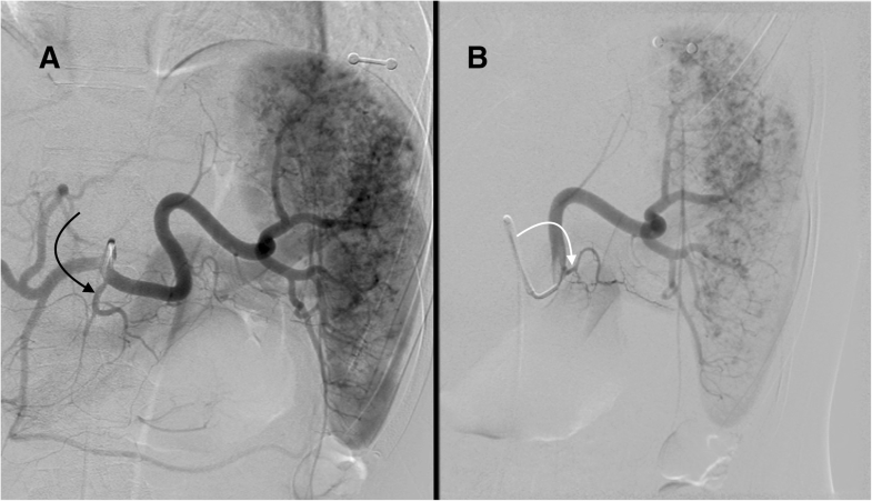 Review of proximal splenic artery embolization in blunt abdominal ...