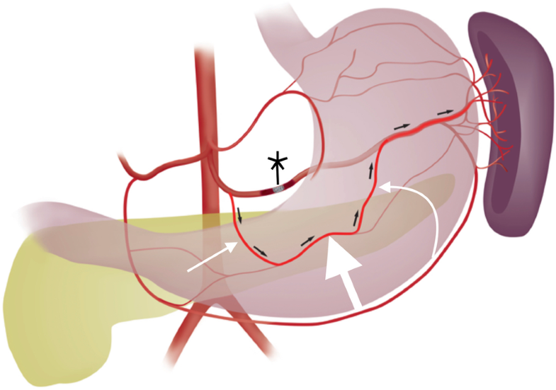 Review of proximal splenic artery embolization in blunt abdominal ...
