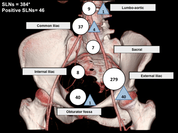 Impact of Indocyanine Green for Sentinel Lymph Node Mapping in Early ...