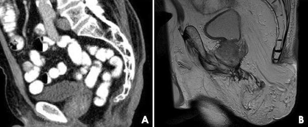Snapshot Study on the Value of Omentoplasty in Abdominoperineal ...