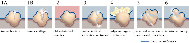 Defining Tumor Rupture in Gastrointestinal Stromal Tumor | SpringerLink