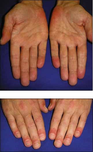 Palmar Erythema | SpringerLink