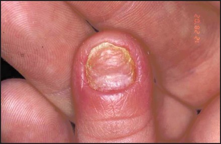 Nail Disorders in Children | SpringerLink