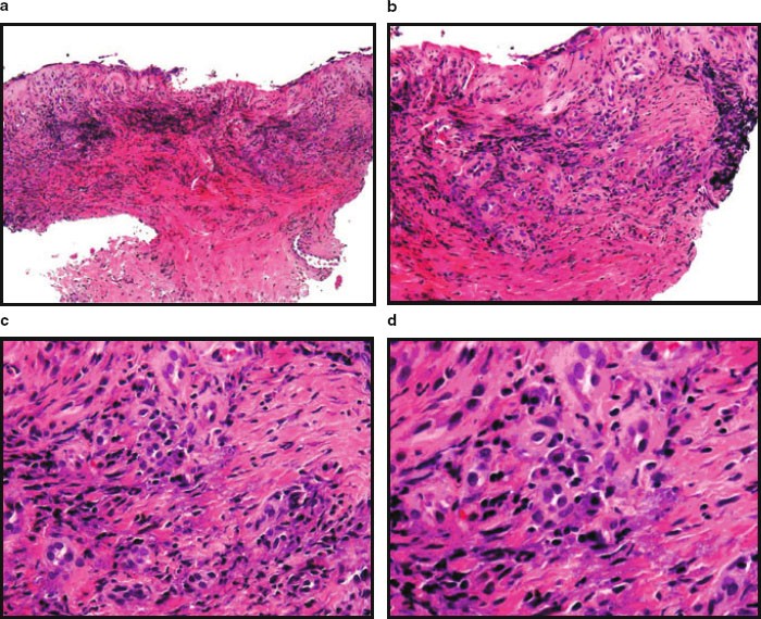Plasma Cell Balanitis Presenting in a Patient with a History of ...
