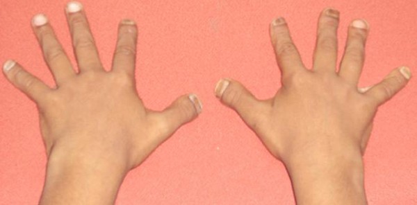 Pycnodysostosis with unusual findings: a case report | Cases Journal ...