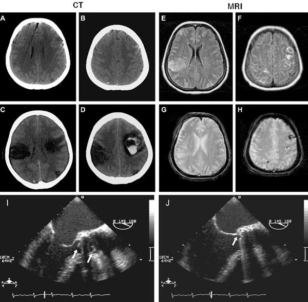 Septic embolic encephalitis after Staphylococcus aureusendocarditis of ...