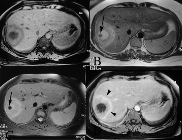 Brucella liver abscess; imaging approach, differential diagnosis, and ...