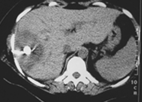 Brucella liver abscess; imaging approach, differential diagnosis, and ...