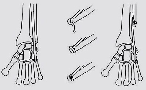 Wide resection and stabilization of ulnar stump by extensor carpi ...