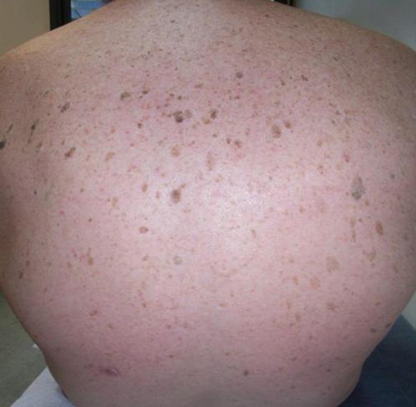 Sign of Leser-Trélat with an adenocarcinoma of the prostate: a case ...