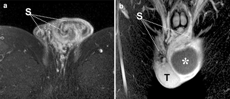 Scrotal Anatomy at MRI | SpringerLink