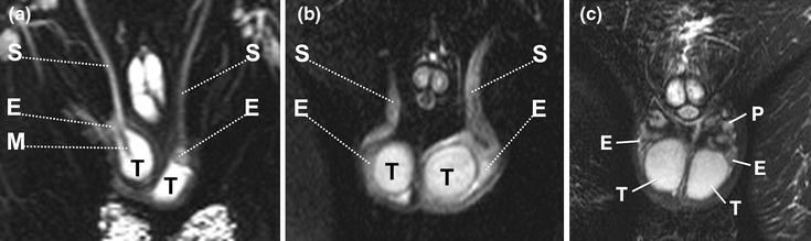 Scrotal Anatomy at MRI | SpringerLink