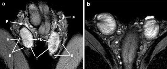 Scrotal Anatomy at MRI | SpringerLink