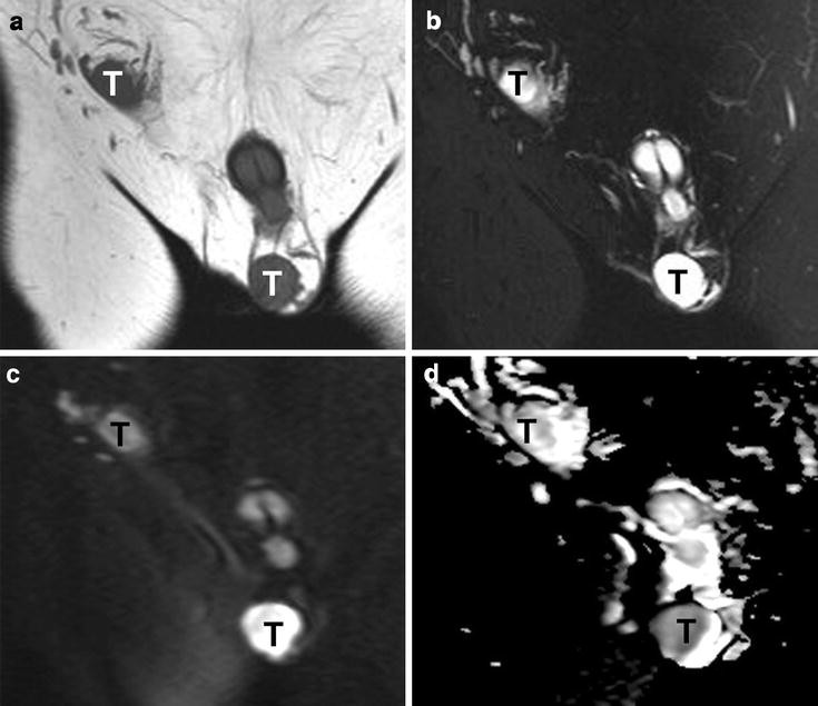 Scrotal Anatomy at MRI | SpringerLink