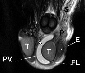 Scrotal Anatomy at MRI | SpringerLink