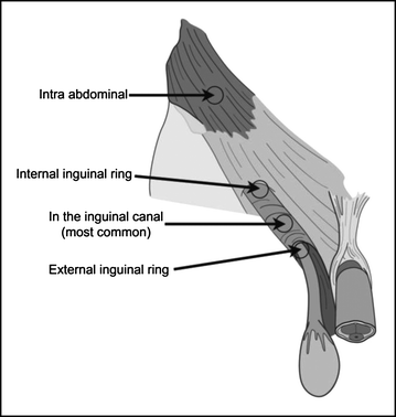 Imaging the Undescended Testis | SpringerLink