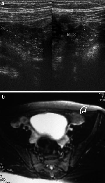 Imaging the Undescended Testis | SpringerLink