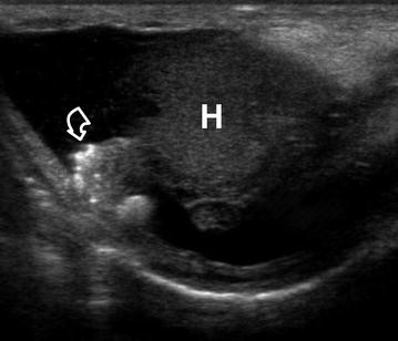Incidental Scrotal Findings at Imaging-1: Calcifications | SpringerLink