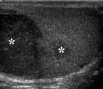 Incidental Scrotal Findings at Imaging-1: Calcifications | SpringerLink